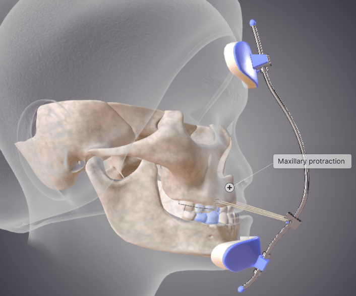 Maxillary protraction and preparation for bone graft | Digital ...