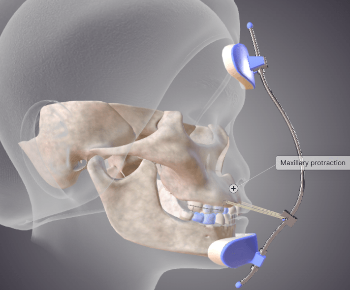 Maxillary protraction and preparation for bone graft | Digital Workflows | FDI